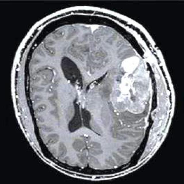 Brain Tumor Semantic Segmentation Dataset By Iotseecs