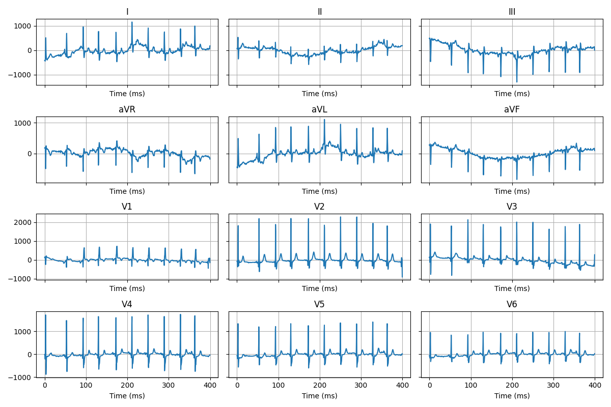 Ecg Classification Dataset And Pre Trained Model By May Sadiq