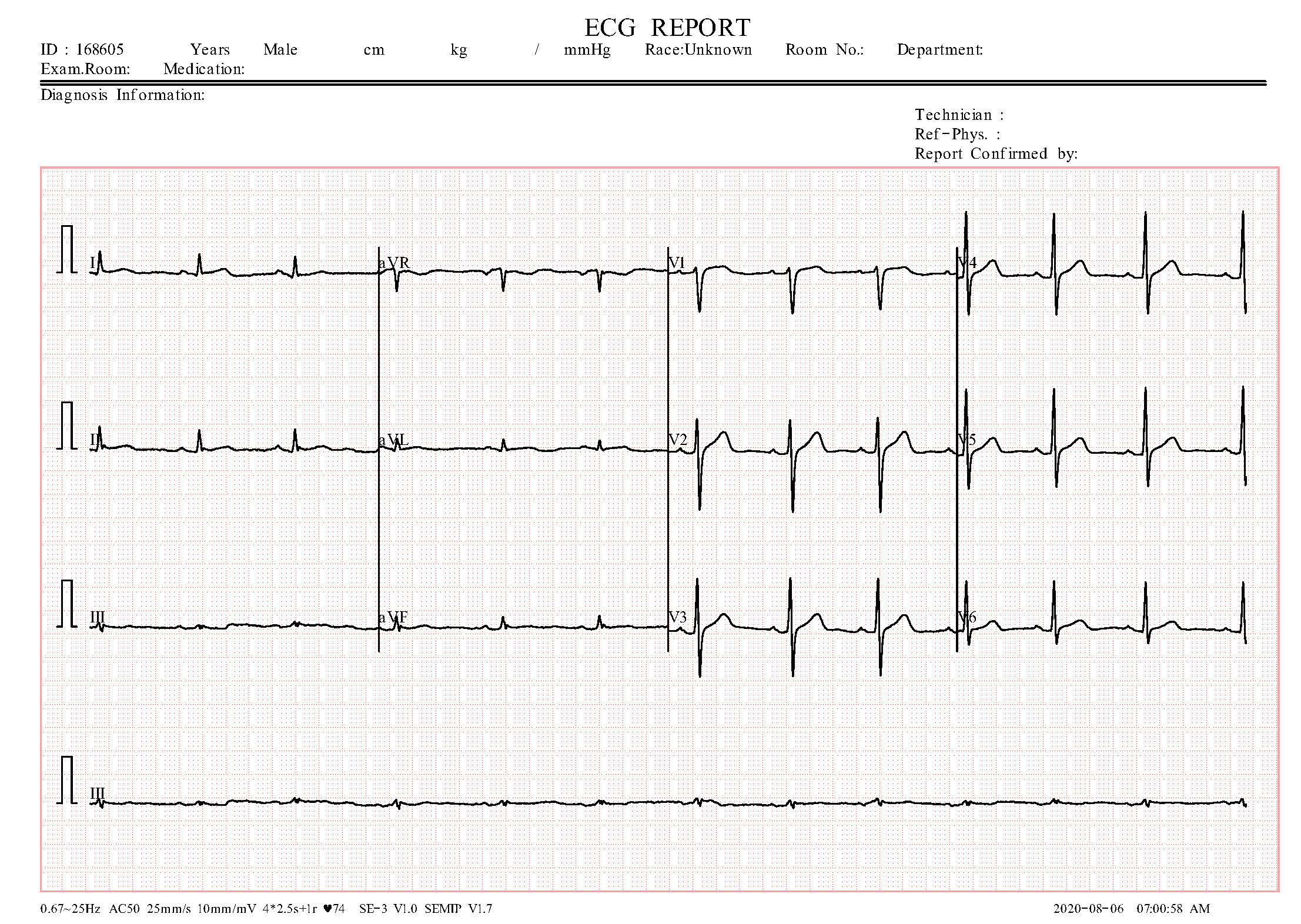 ecg-disease Classification Dataset by ecgclass