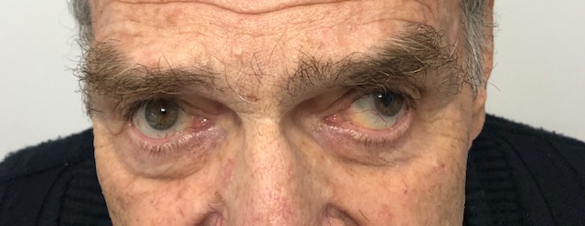 Strab1 Object Detection Model by Strabismus