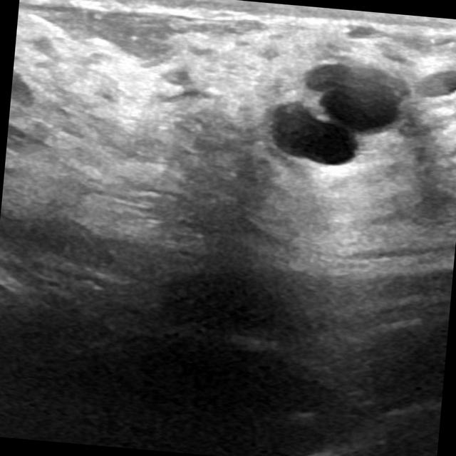 Breast Cancer Segmentation Instance Segmentation Dataset And Pre Trained Model By Septi Anggia