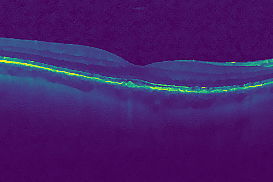 Drusen Object Detection Model by AMD