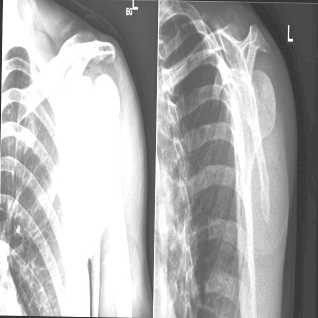 Break bone Object Detection Model by Bone Fracture Detection