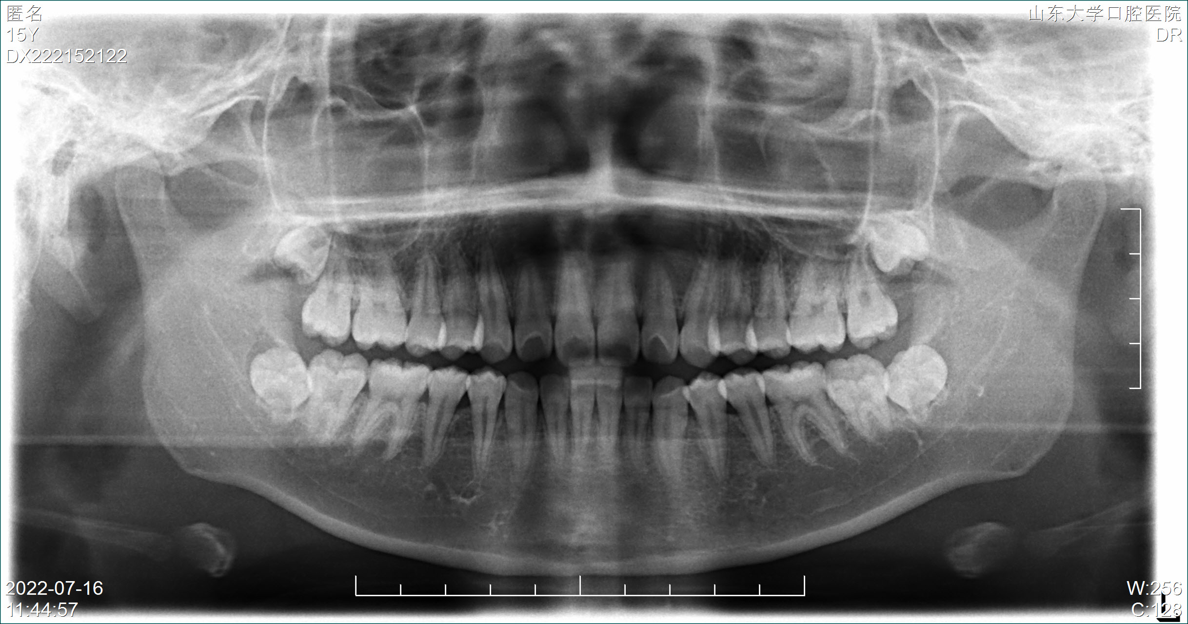Root Canal Detection Object Detection Dataset By 2023toothdataset