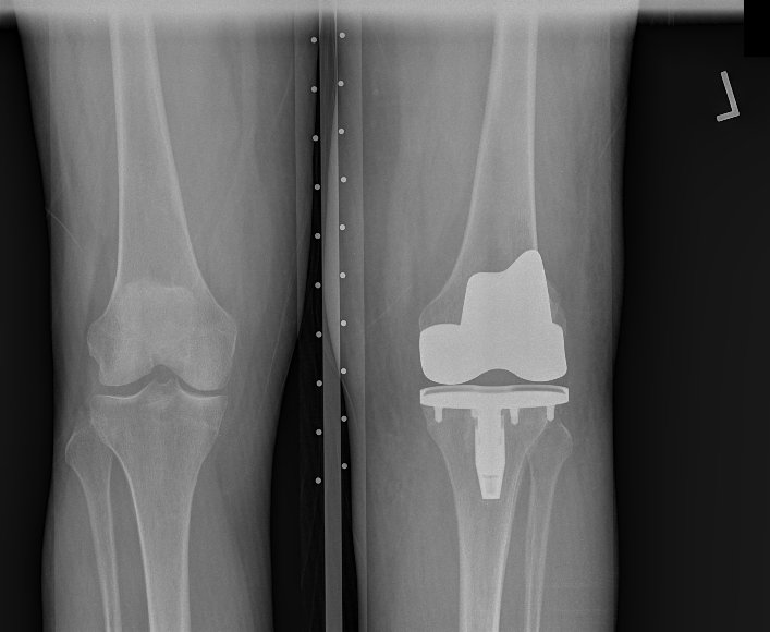 Knee Dataset Roboflow Universe