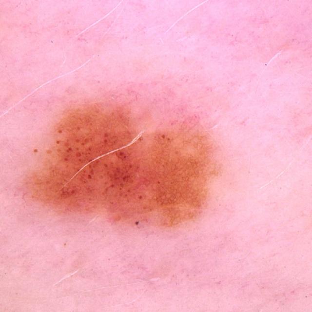 skin-cancer Object Detection Dataset and Pre-Trained Model by Burak Yilmaz