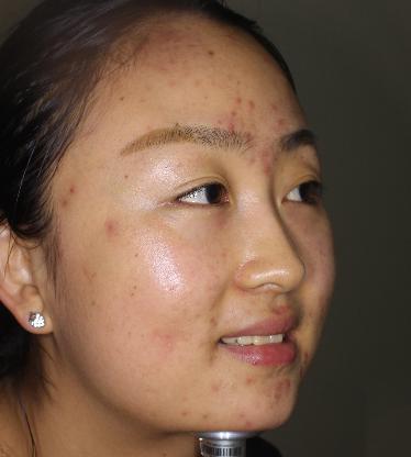 Skin Test Object Detection Dataset by skindataconversion