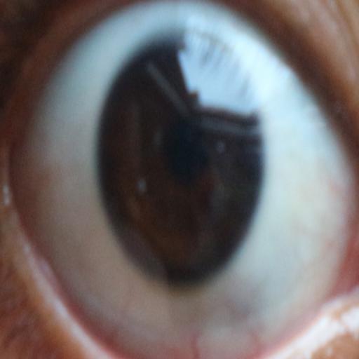 Optiscan Cataract Detection Instance Segmentation Dataset And Pre