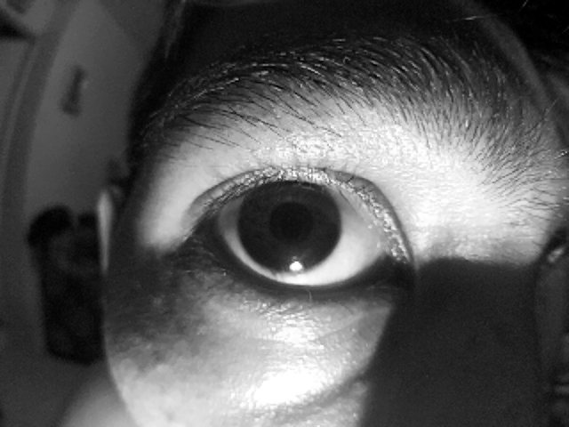 Optiscan Cataract Detection Instance Segmentation Dataset And Pre Trained Model By Christopher