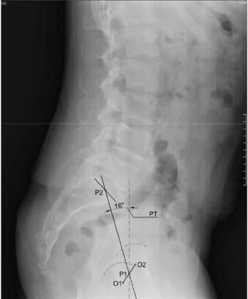 Spine Semantic Segmentation Dataset and Pre-Trained Model by Yuktha