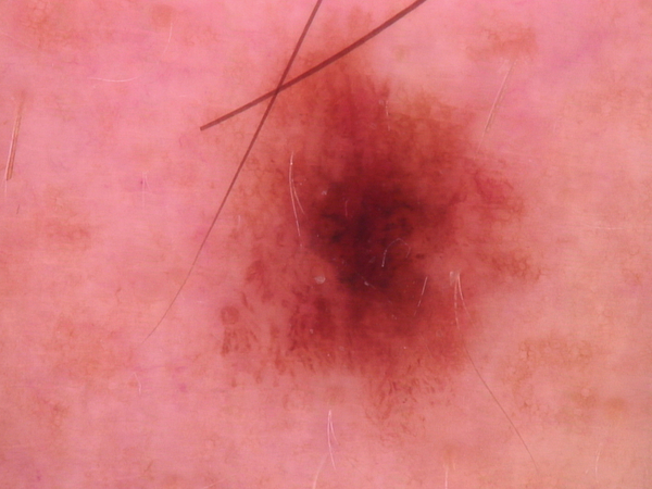 Skin Cancer Object Detection Dataset by Cello Bow Hold