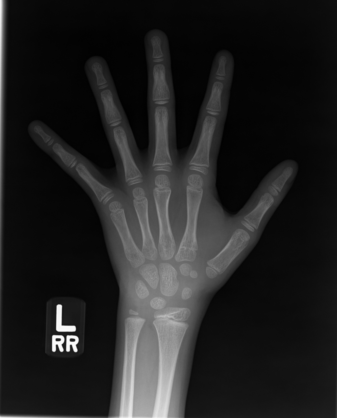 Bone Age Male Classification Dataset V3 2024 09 30 1210am By Male