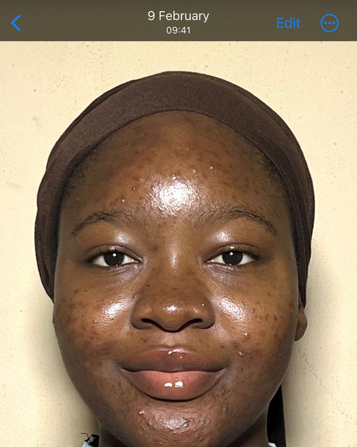 Skin care Instance Segmentation Model by Taralina