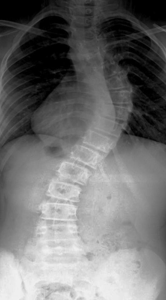 Scoliosis Object Detection Dataset By Usama