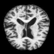 MRI - Alzheimer Instance Segmentation Dataset by MRI Alzheimer