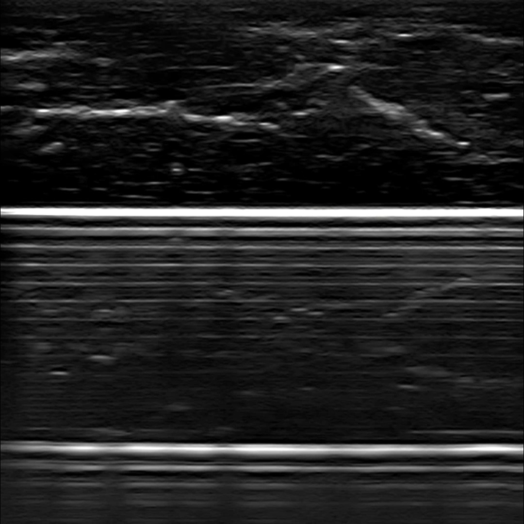 needle tracking liver 06 Object Detection Dataset by needledemo