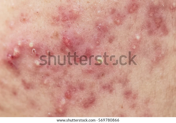 Acne Detection Object Detection Dataset And Pre Trained Model By Acne