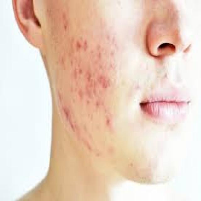 Acne Detection Object Detection Dataset By Spark002